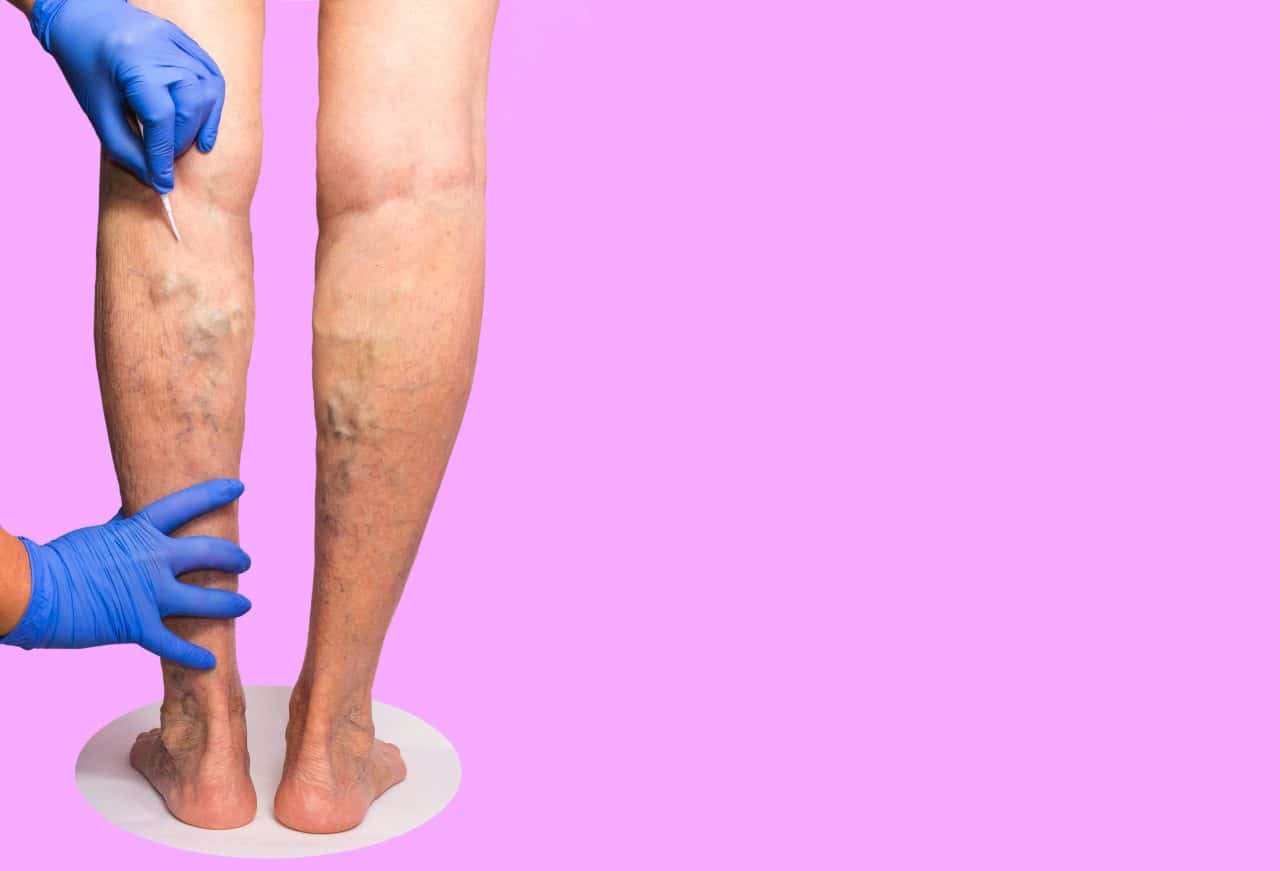 What are The Treatment Options for Varicose Veins? | Vein Treatment NJ